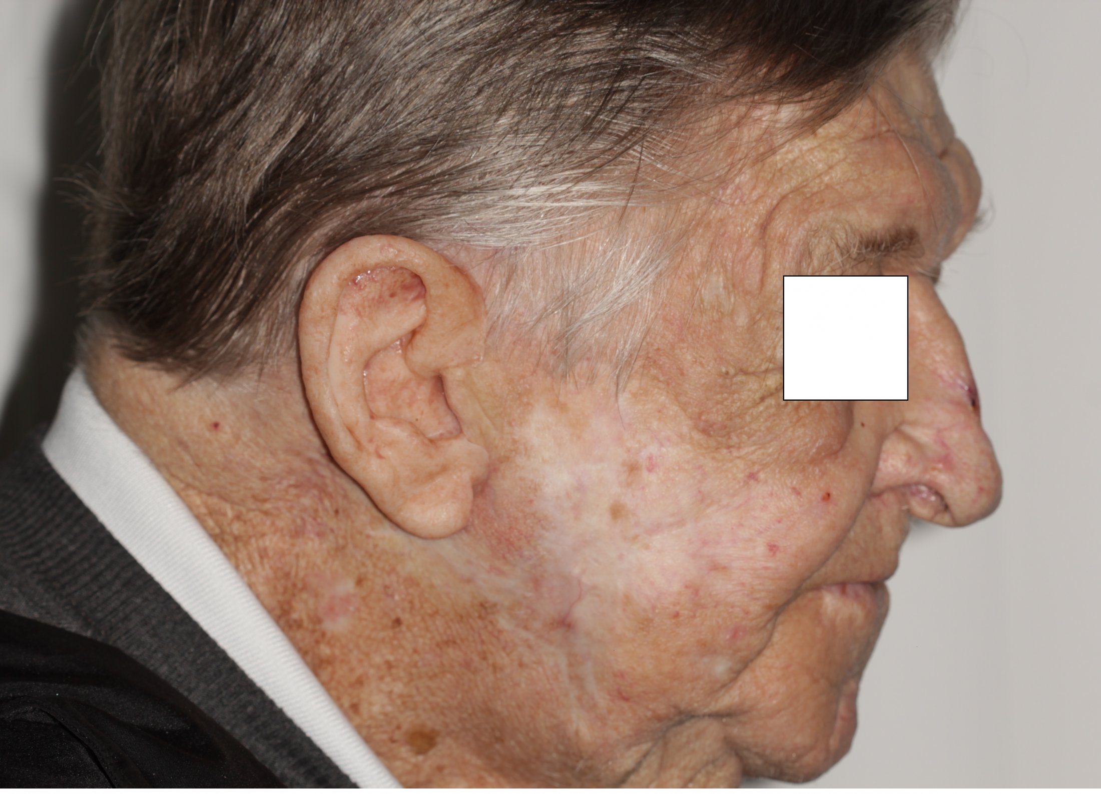 Maxillofacial Prosthetics Gallery | Before & After Prosthesis Pictures