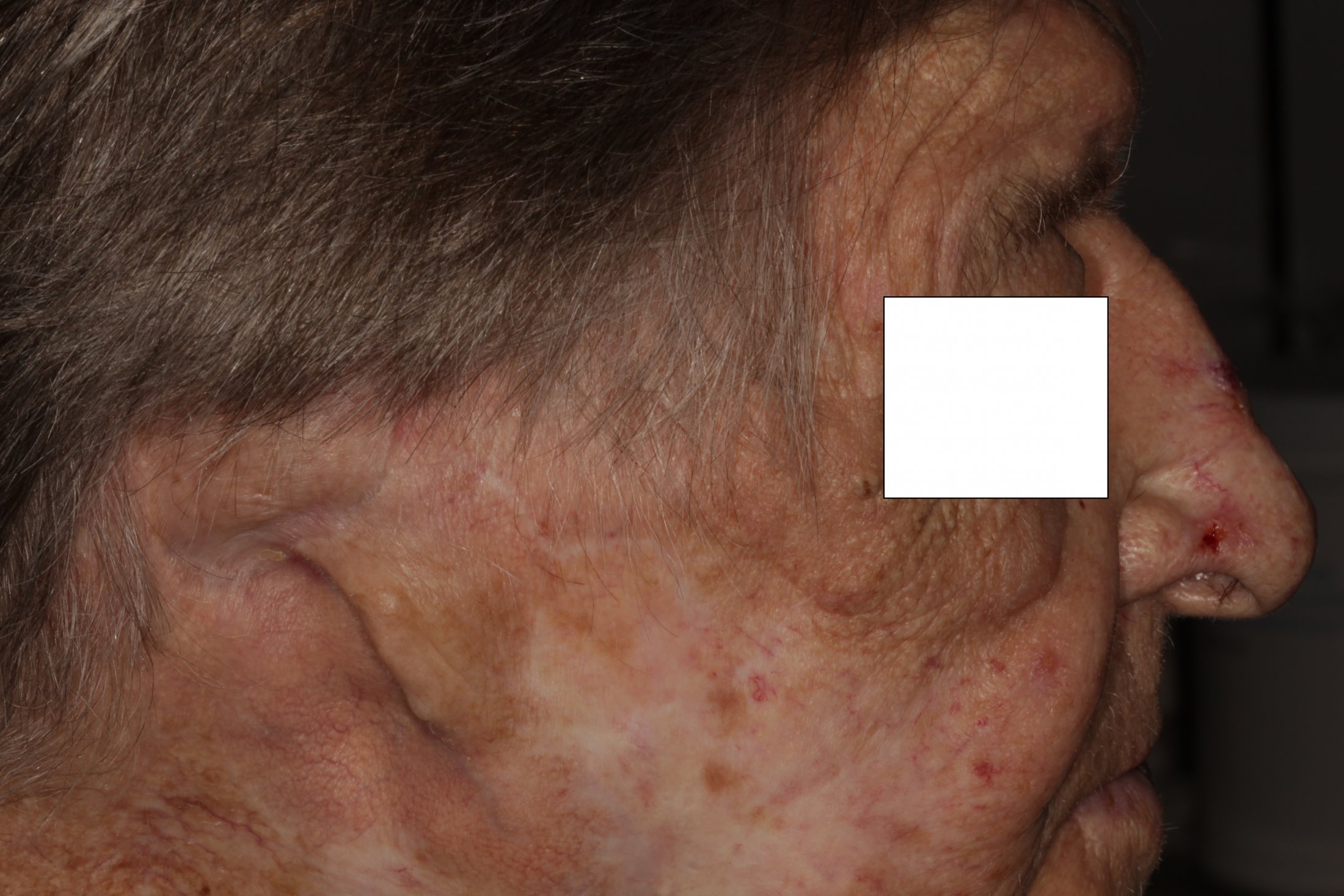 Maxillofacial Prosthetics Gallery | Before & After Prosthesis Pictures
