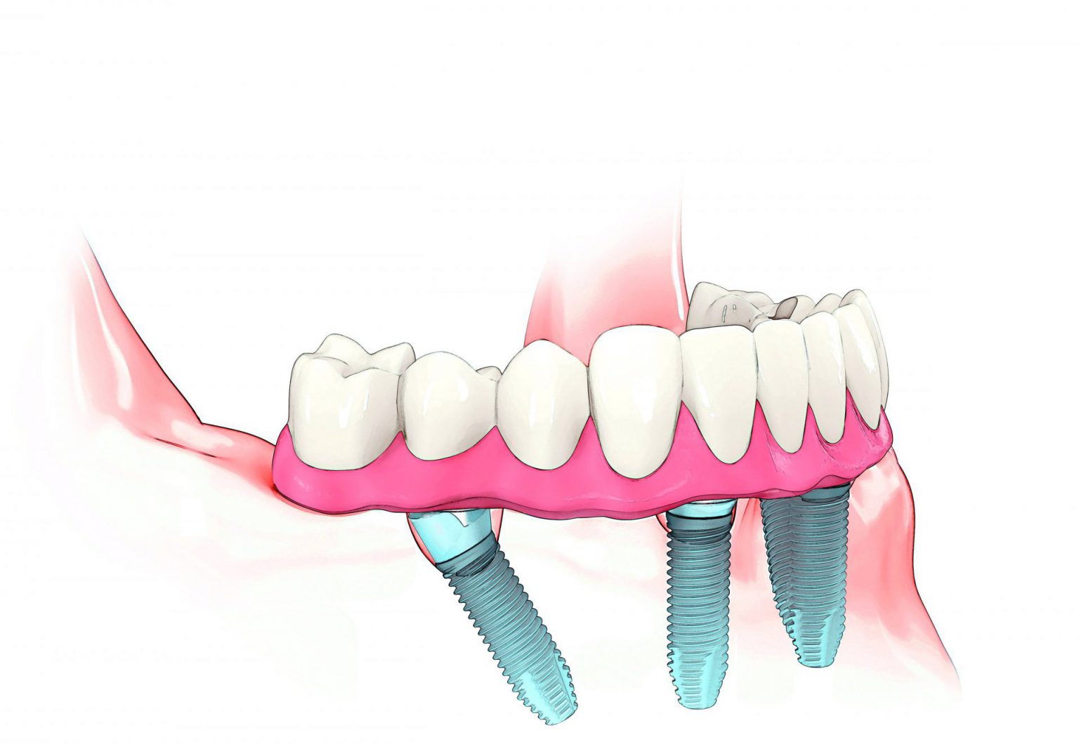 Teeth in a Day La Mesa CA, San Diego Prosthodontics
